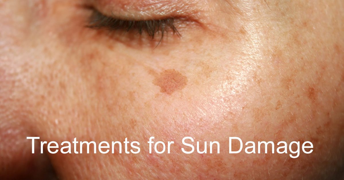 Sun Damage Skin Treatments | Rejuvience Med Spa