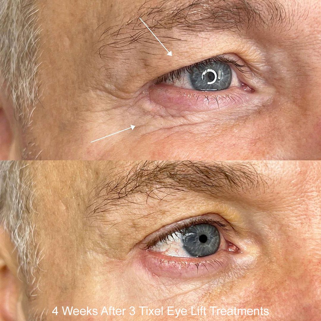 Non-Surgical Tixel Eyelid Lift | Scottsdale Med Spa