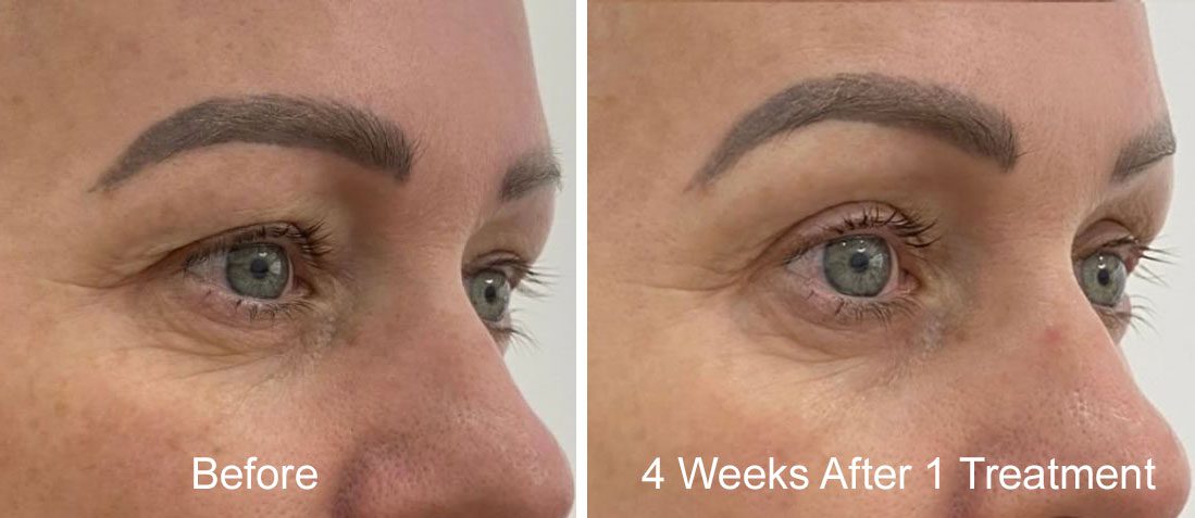 Tixel Eyelid Lift | Rejuvience Med Spa Scottsdale
