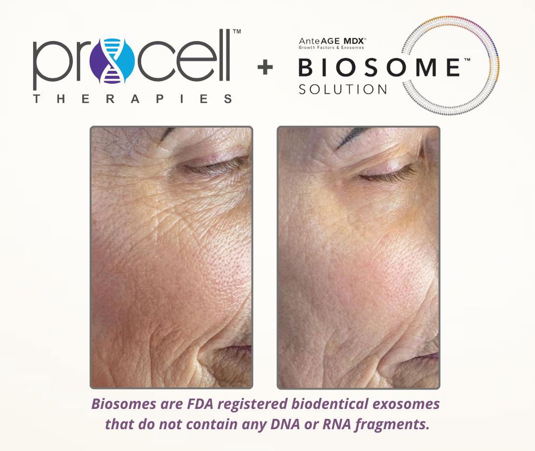 Procell Microchanneling Scottsdale with AnteAGE Biosomes – Rejuvience ...